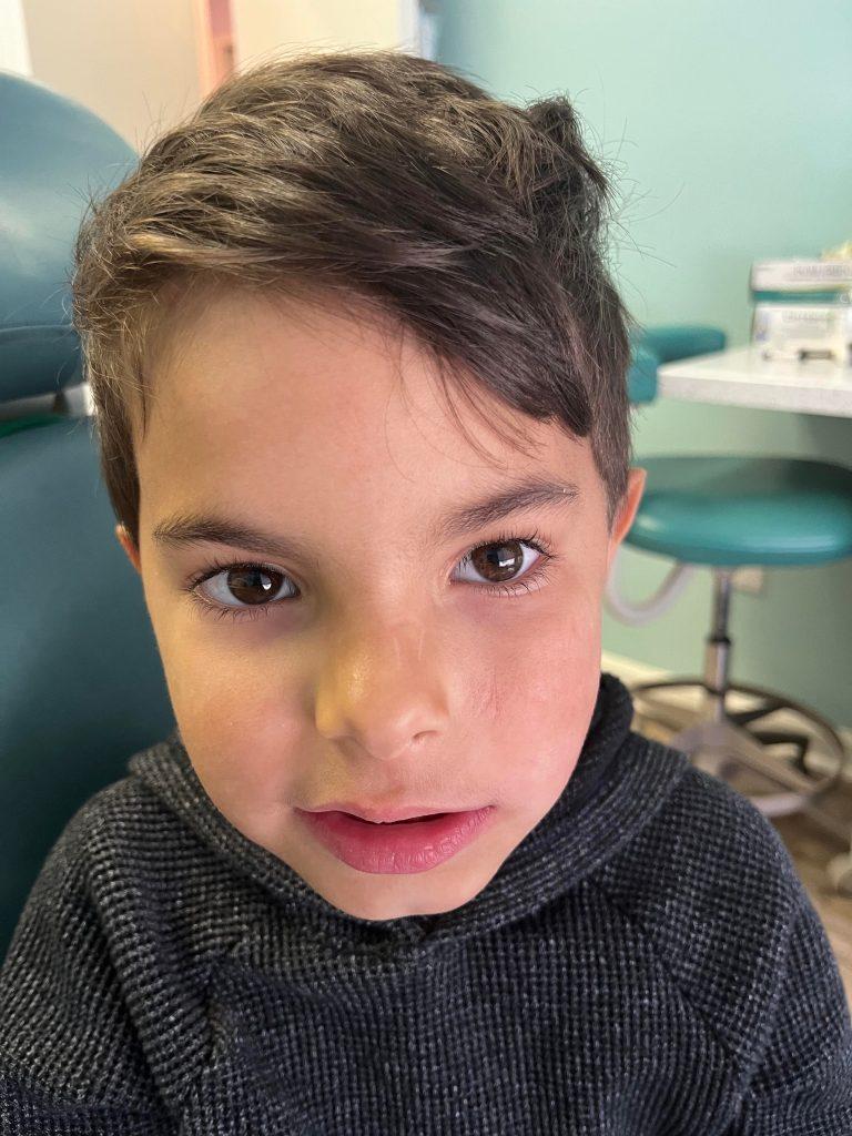 Cavity Fillings in Baby Teeth: Is It Necessary? And What Can You Expect?
